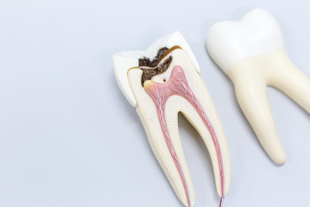 Saving Teeth Through Vital Pulp Therapy - Zyris - Makers of the Isolite ...