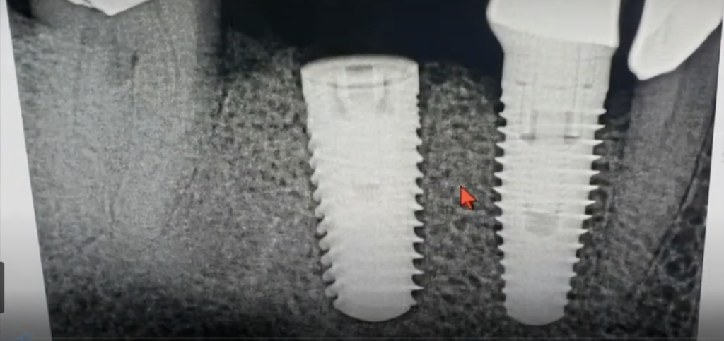 Delivering the Highest Standard of Care: Dental Implants - Zyris ...