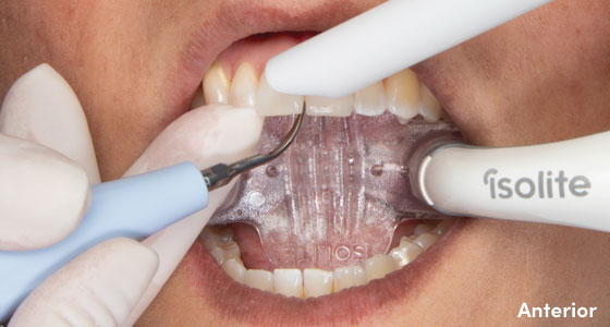 Mouthpieces - Zyris - Makers of the Isolite System